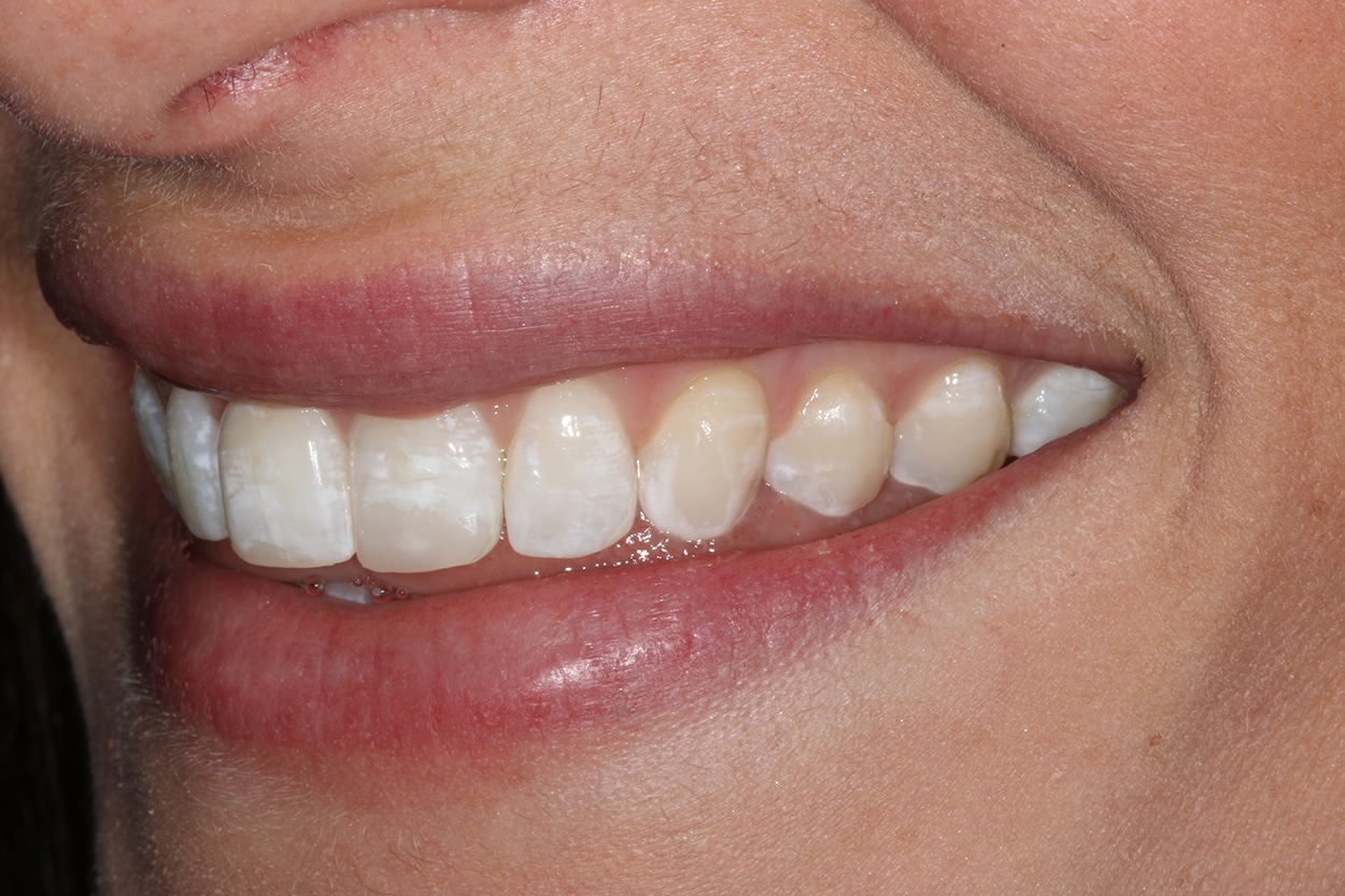 Rachael’s Invisalign Journey - Dr Steven Casci